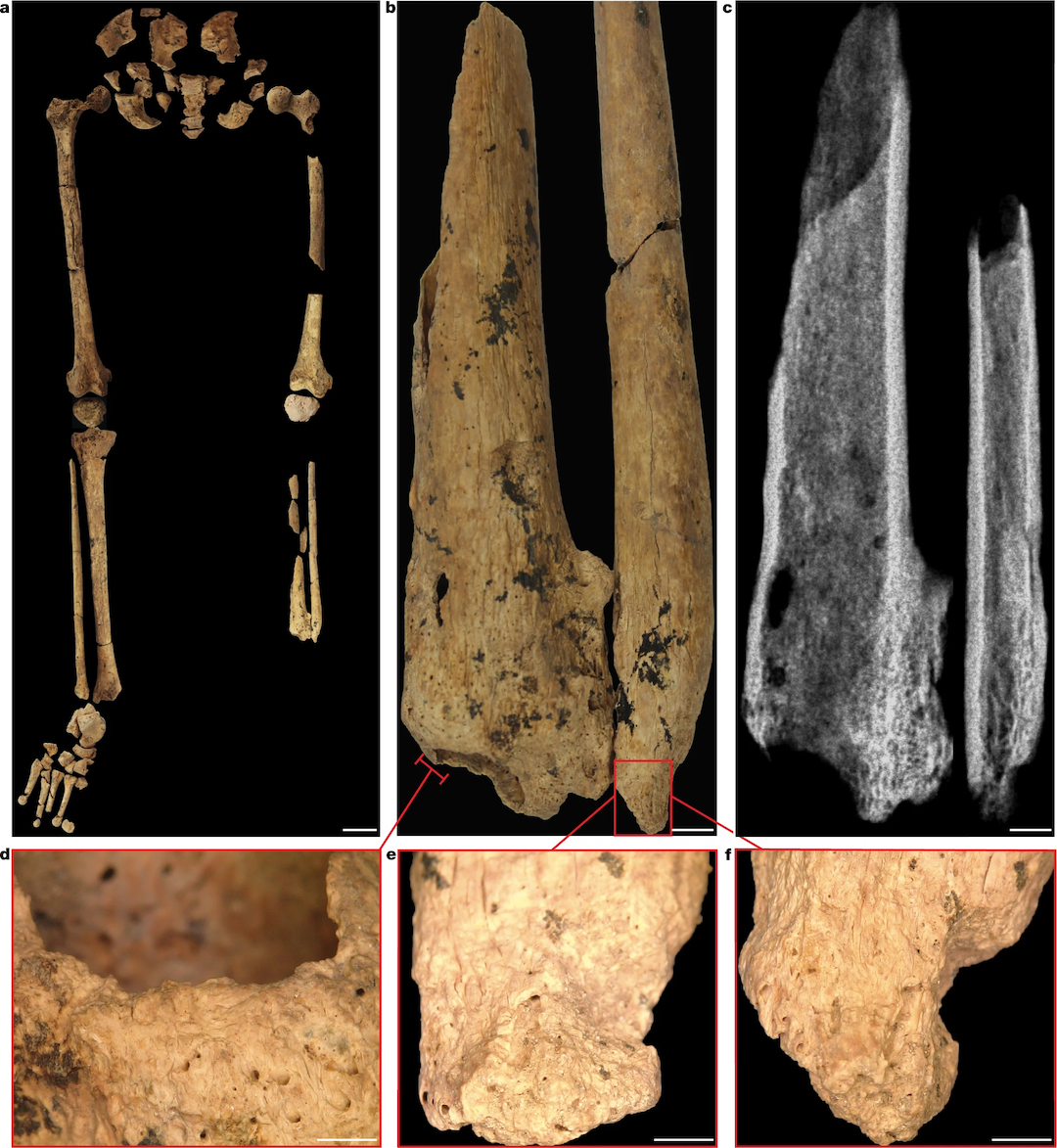 Oldest Evidence Of Surgical Amputation Dates Back 31,000 Years ...